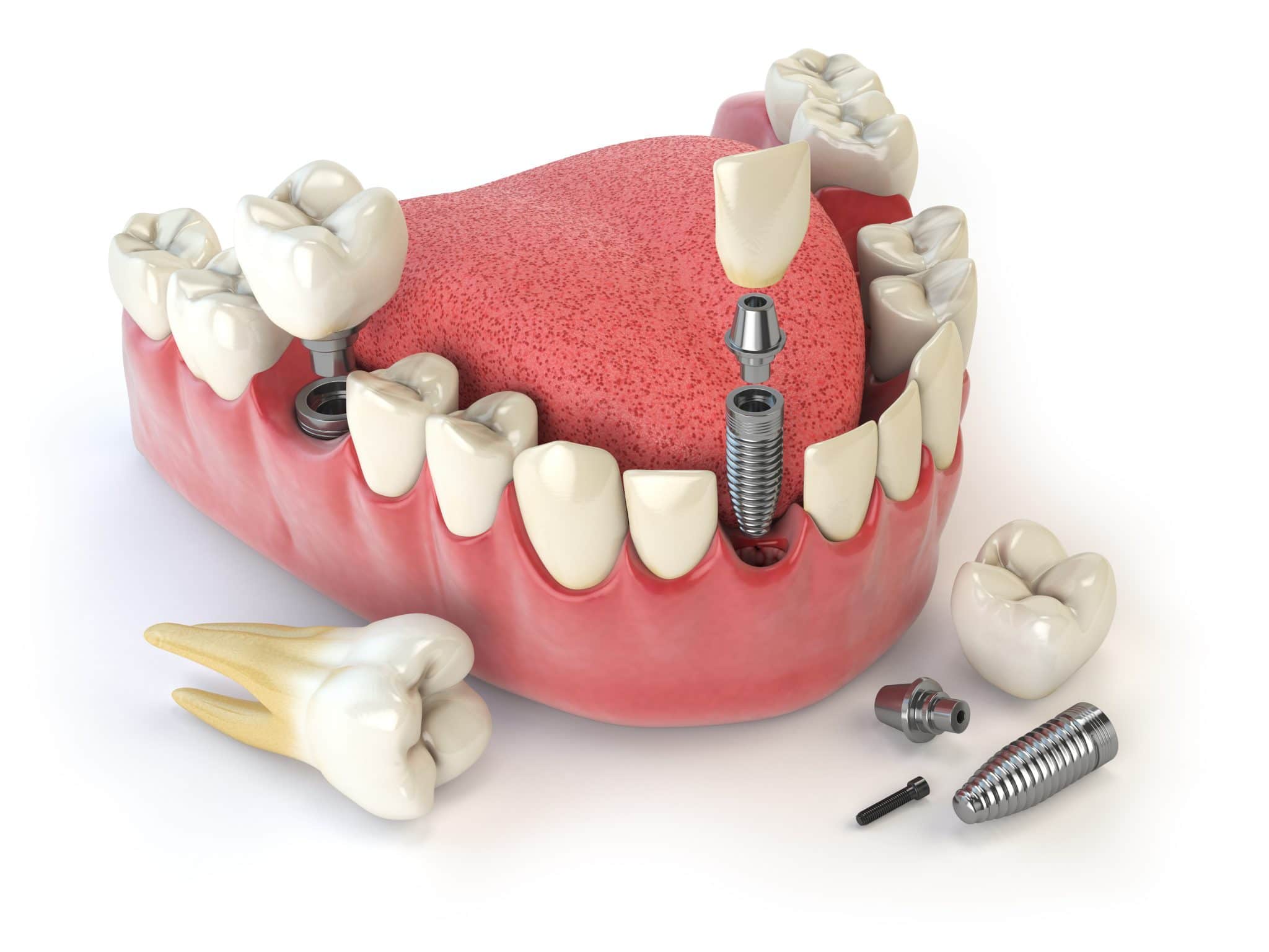 Restoring Your Smile With A Dental Implant | Dallas, TX