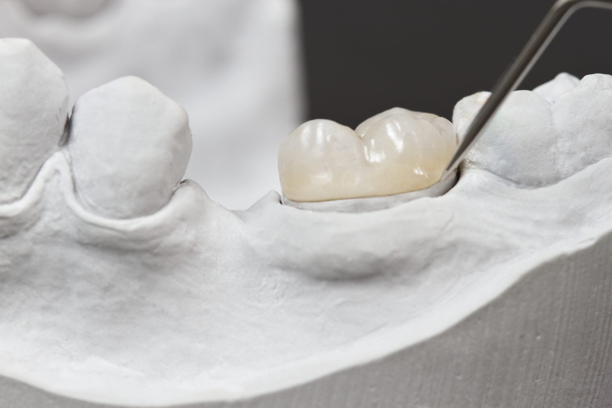 Three Ways Dental Crowns Protect Your Smile | Dallas, TX